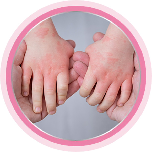 baby rash on cheeks from drool